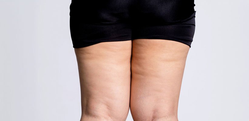 Identificando e Tratando Lipedema: Sintomas e Soluções - Dr. Rafael ...